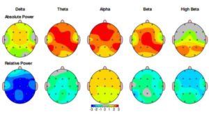 QEEG Brainmap - Hersenonderzoek - QEEG - Brainmed