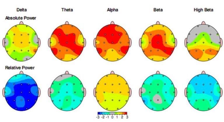 QEEG Brainmap - Hersenonderzoek - QEEG - Brainmed