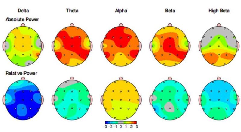 QEEG Brainmap - Hersenonderzoek - QEEG - Brainmed