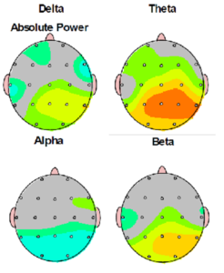QEEG bij autisme - QEEG Subtypen bij autisme | ASS - Brainmed